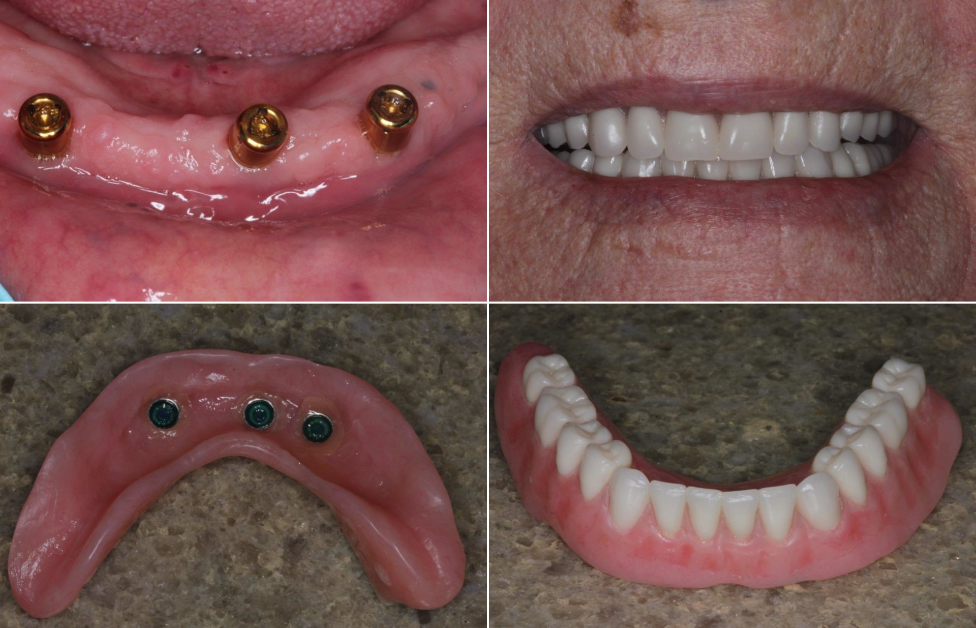 Dentures / Partials | Lake District Family Dentistry